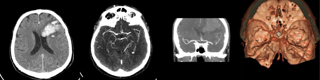 Angiografia CT